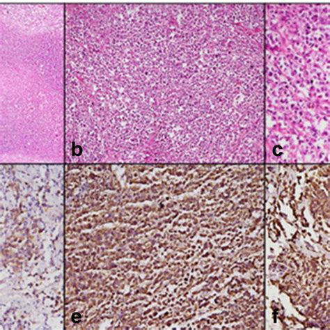 Ncct Head Thorax And Abdomen Showing Scalp Metastasis Breast Download Scientific Diagram