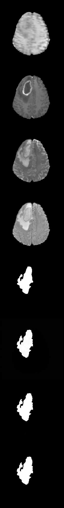Why The Results Look Good But The Dice Are Very Low？ · Issue 60 · Supermedintel Medsegdiff