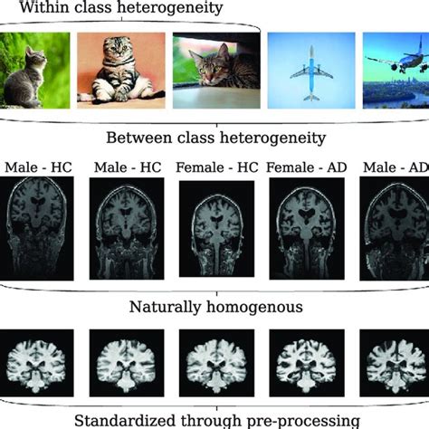 Mri Scan Of A Patient With Ms With A Heatmap Overlayed At Different