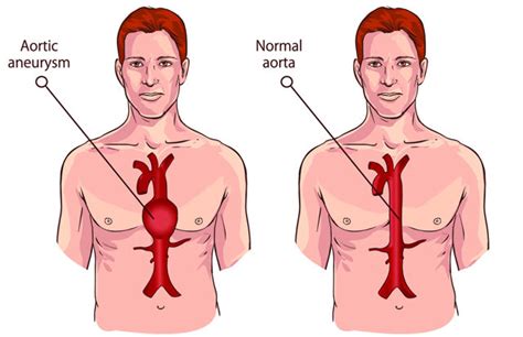 Aortic Aneurysm