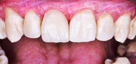 Simplified Layering Is The Key For Magic Results Myzerodonto