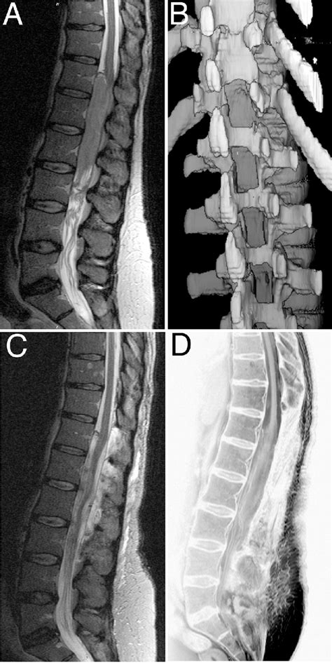 Case 2 A Preoperative Mr Image Demonstrating An Intradural Download Scientific Diagram