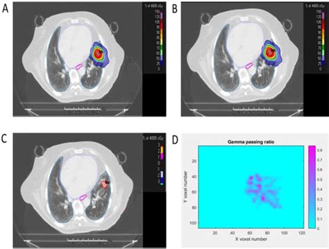 A Representative Of The Lung Cancer Case A Static Nominal Plan Dose Download Scientific