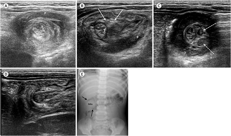 Meniscus Sign Intussusception