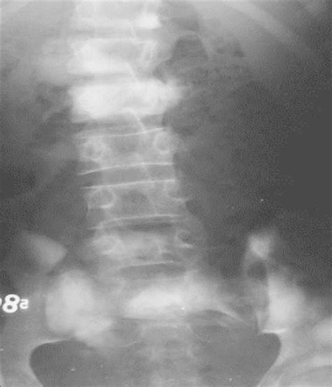 A 14 Year Old Male With Multicentric Osteosarcoma Ap Radiograph Of Ls Download Scientific