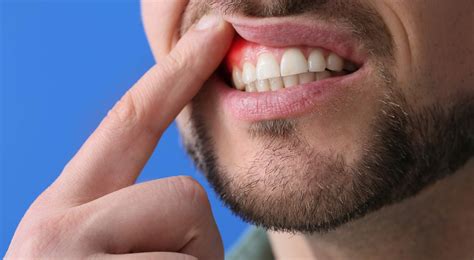 What Causes Sensitive Gums Treatments For Your Sore Mouth