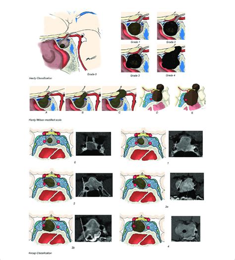 Hardy Wilson And Knosp Classifications Hardy Wilson Classification Hardy Wilson And Knosp Classifications Hardy Wilson Classification