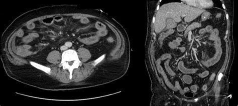Contrast‐enhanced Ct Showed Mucosal Contrast Effect And Submucosal Download Scientific Diagram