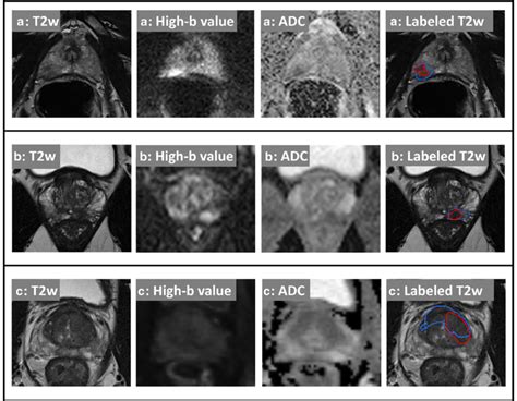 Case Examples From Left To Right T2w Dwi High B Value Adc Map And Download Scientific