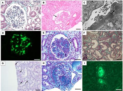 Diffuse Proliferative Glomerulonephritis Em