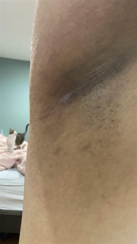 Persistent Armpit Rash : r/DermatologyQuestions