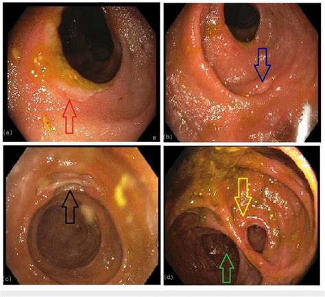 Ulcers In Colon