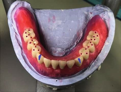 Distribution Of Static Red And Dynamic Blue Occlusal Contacts In