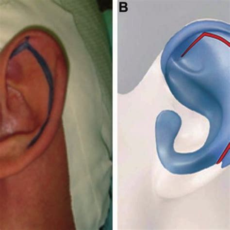 A The Antihelix Is Reshaped Through Disconnection And Sutures B