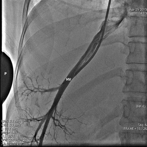 Prebiopsy Right Hepatic Venogram Anteroposterior View Hv Right