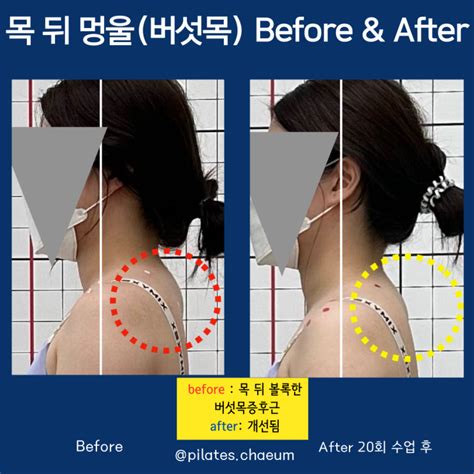 [2동탄필라테스] 뒷목 땡김 두통 해결하는 방법 공개합니다 2동탄체형교정 동탄체형교정 네이버 블로그