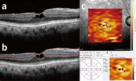 An Example Of Automated Retinal Layer Segmentation With Spectral