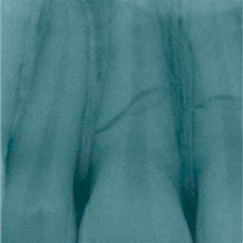 Pdf Treatment Of Horizontal Root Fracture A Case Report