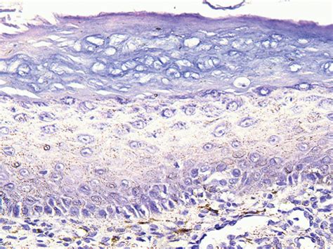 Immunohistochemical Staining Of Mmp1 In Human Hnscc Samples A B