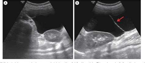 Figure 1 From A Case Of Huge Retroperitoneal Cystic Mesothelioma Mimicking Diffuse Ascites