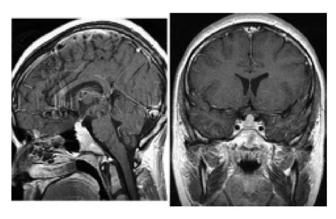 Suprasellar Cistern Location