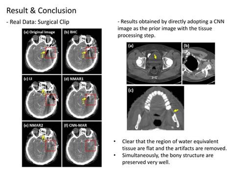 Convolutional Neural Network Based Metal Artifact Reduction In X Ray