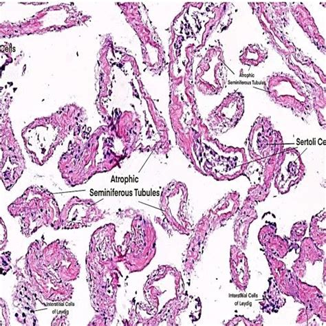 First TESE Before Treatment Reveals The Atrophic Change Of Download Scientific Diagram