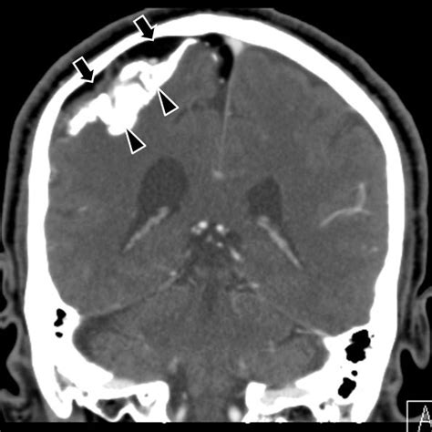 Pdf Intracranial Convexity Lipoma With Massive Calcification Case Report