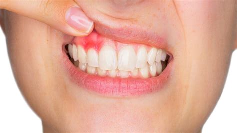 Early Signs Of Gum Disease You Might Ignore Goodfaith Dental Care