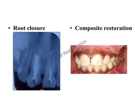Revascularisation Ppt Free Download Revascularisation Ppt Free Download