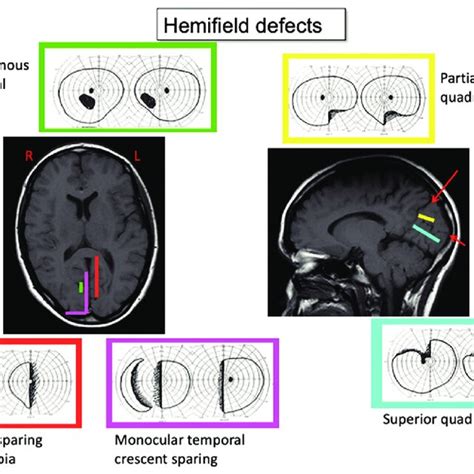 Hemifield Defects From Lesions Of Striate Cortex Defects Are Highly