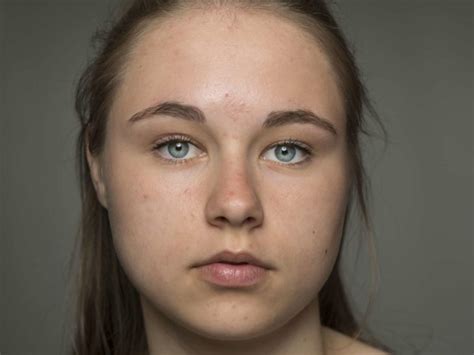 I Keep Getting A Pimple In The Middle Of My Forehead Fleetlasopa