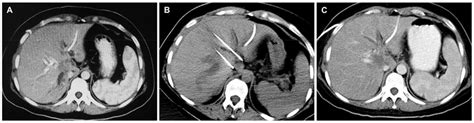 A 53 Year Old Male With Unresectable Hilar Cholangiocarcinoma Treated