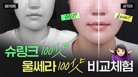 울쎄라 100샷 Vs 슈링크 100샷 반반 시술 받아봤습니다 Youtube