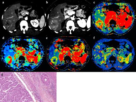 Dual Energy Ct Dect And Perfusion Ct Images In A 31 Year Old Man With
