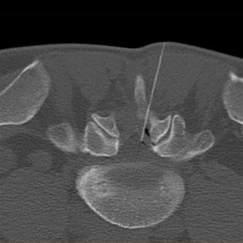 Epidural Injections Factsheet Melbourne Radiology