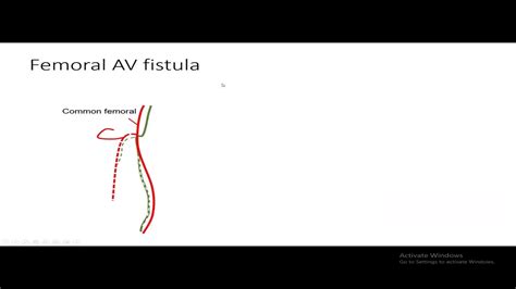 Femoral Access Cardiology Angiography Pptx