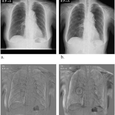 Digital Chest X Ray Technique Improves Detection Of Lung Lesions TrendRadars