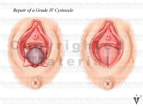 Cystocele Grading