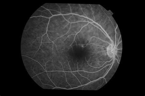 Cscr Retina Image Bank