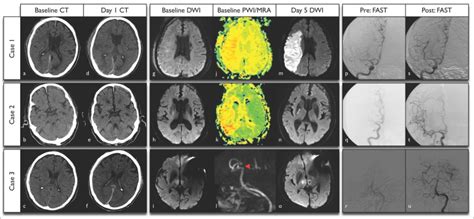 Summary Of Imaging And Angiographic Findings In 3 Cases A F Brain Ct Download Scientific