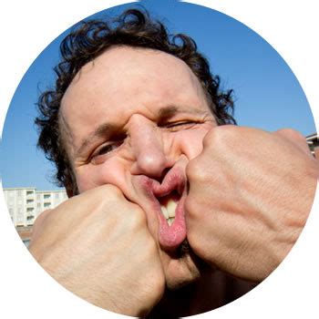 Facial Injuries Fractured Cheekbone Around The Face