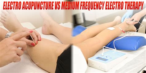 Electroacupuncture Vs Medium Frequency Electrotherapy Sciatica Artofit
