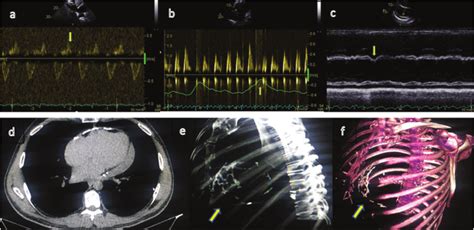 A Hepatic Flow Reversal With Ivc Plethora B Hemodynamic Information Download Scientific A Hepatic Flow Reversal With Ivc Plethora B Hemodynamic Information Download Scientific
