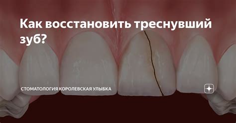 Как восстановить треснувший зуб Стоматология Королевская улыбка Дзен