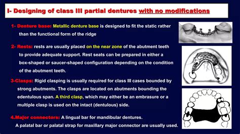 2 B Basic Principles For Designing Kennedy Class Ii Iii And Iv