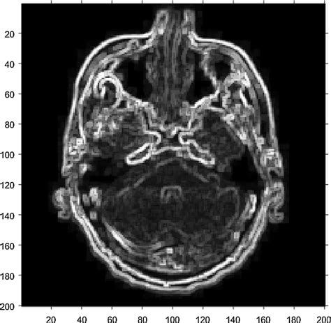 edge detection without segmentation in occipital lobe and zygomatic