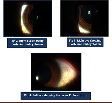 Posterior Embryotoxon