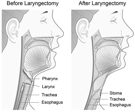 Laryngectomy Causes Symptoms Treatment Laryngectomy
