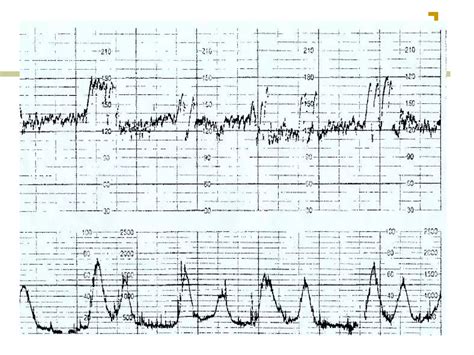 Cardiotocography Ctg Ppt